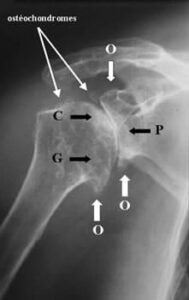 Radiographie de l'arthrose - Oasis Training Platform